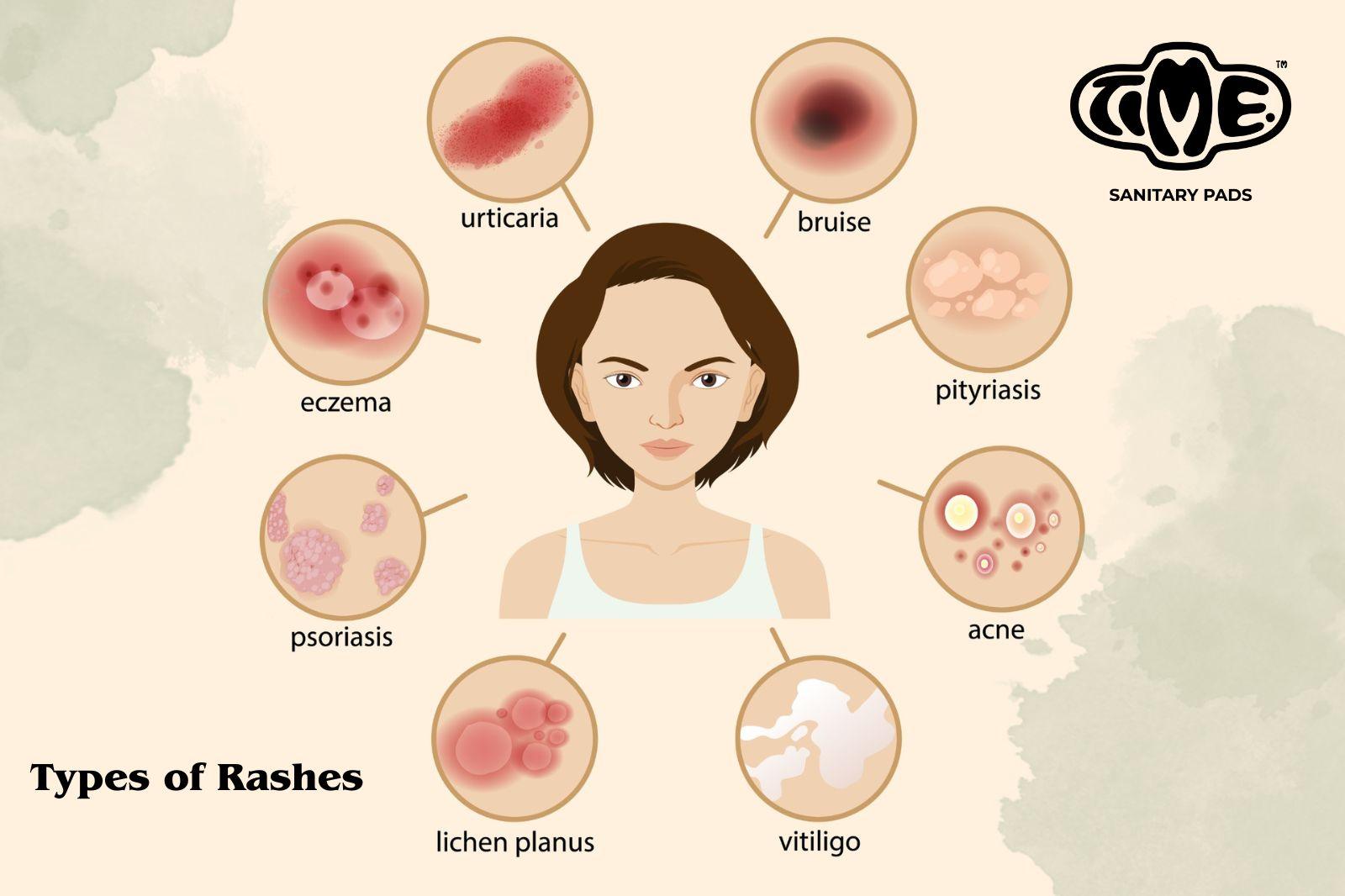 Understanding Period Dermatitis: Symptoms and Solutions – Time Sanitary ...